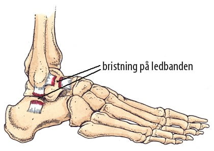 Ledbandsskada - Stukad Fotled - Fotcenter